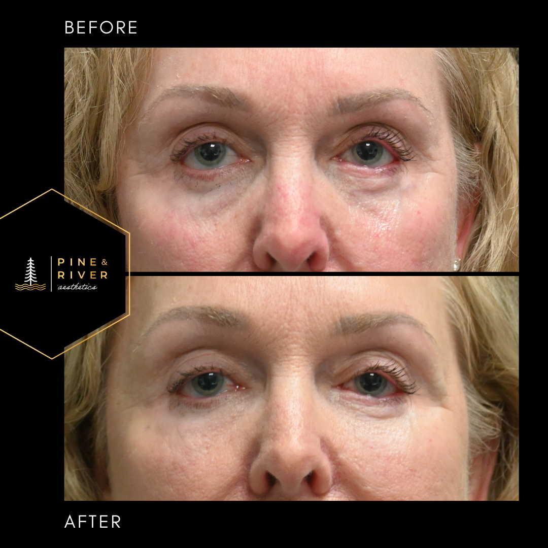 Best Treatments for Under-Eye Issues: Bags, Wrinkles & More | McFarland ...