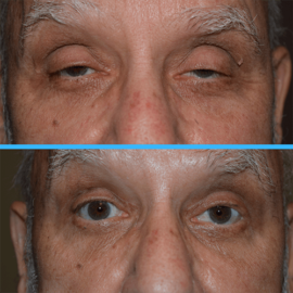 Signs Your Eyelids Are Affecting Your Vision | McFarland Eye Care